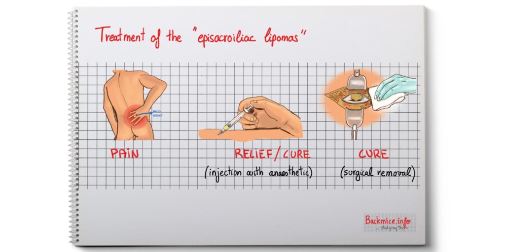 Episacroiliac lipoma (or back mice) | backmice.info