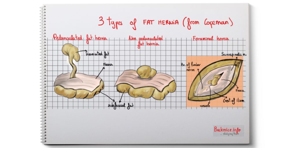 Clinical and therapeutic aspects of hernia of the panniculus adiposus ...
