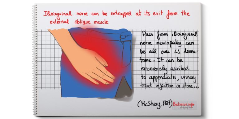 1987 McSherry – Ilio-inguinal nerve | backmice.info